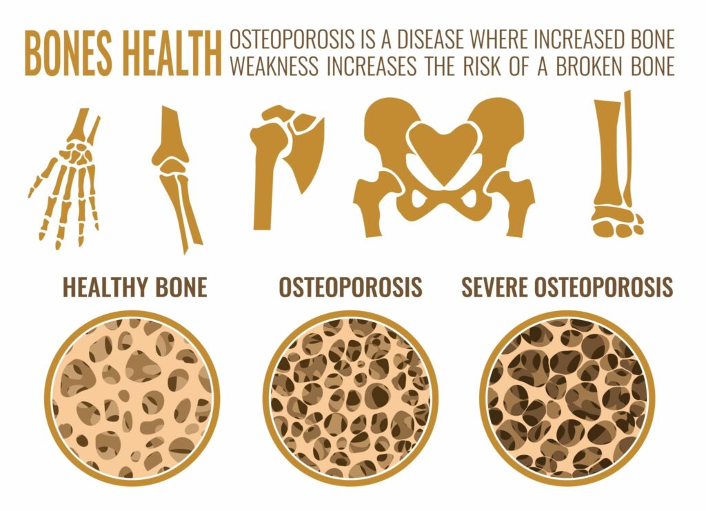 Yoga For Osteoporosis Near Me? Try A Strong Bones Sequence